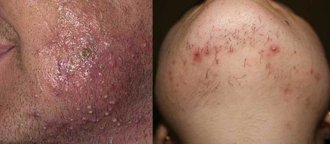 Ingrown Beard Hair-Remove, Prevent & Treatment Options Ingrown Facial ...