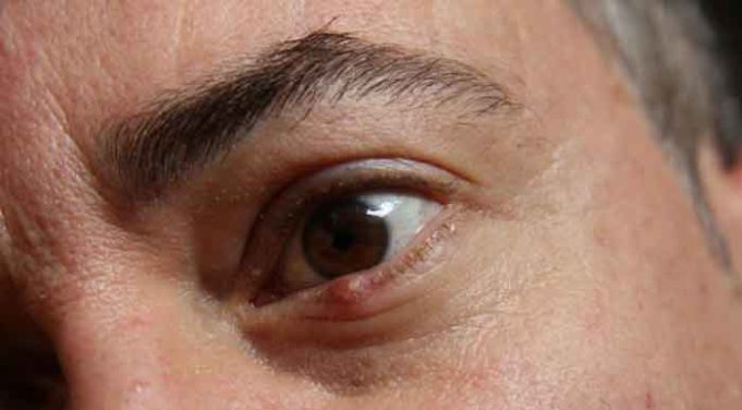 Ingrown Eyelashes- How to Remove, get Rid, Upper, Lower Eyelid, Stye ...