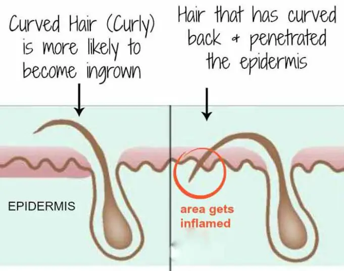 Ingrown Hair on Breast & Chest Male & Female | CureHows